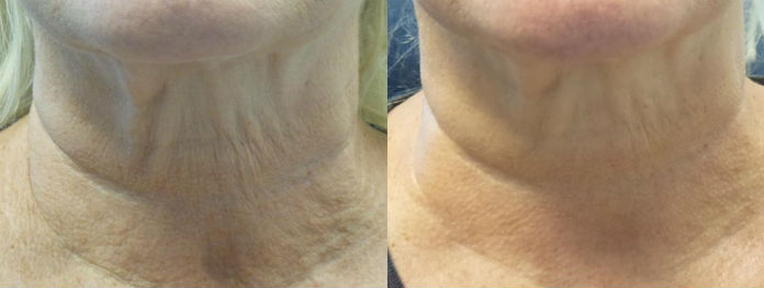 Skin Tightening Pelleve Honolulu HI Skin Tightening Pelleve Honolulu HI