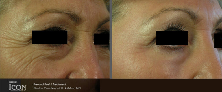 ICON Laser Skin Resurfacing and IPL Honolulu HI